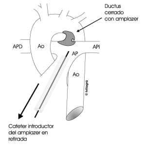 Ductus - La web de las Cardiopatías Congénitas