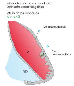 Miocardiopatía no compactada