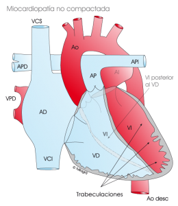 Miocardiopatía no compactada