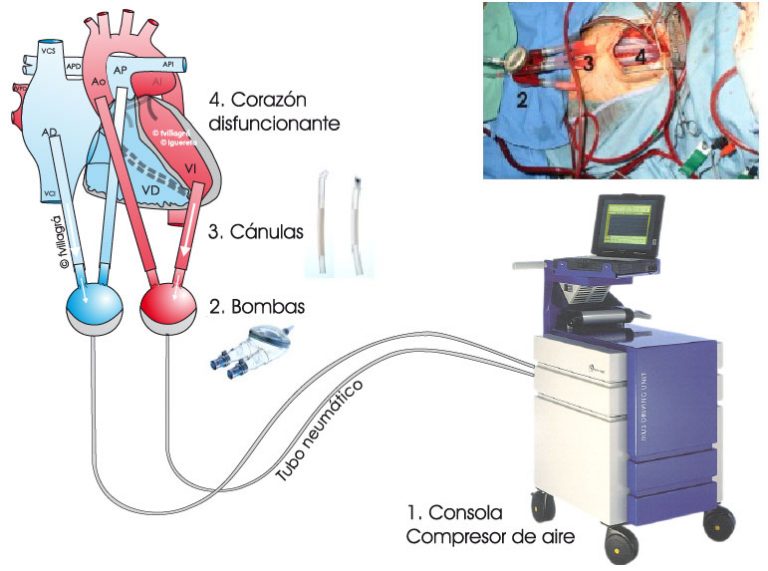 Berlin Heart - La web de las Cardiopatías Congénitas
