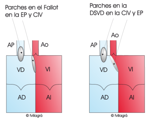 Doble salida del ventrículo derecho (DSVD) - La web de las Cardiopatías ...