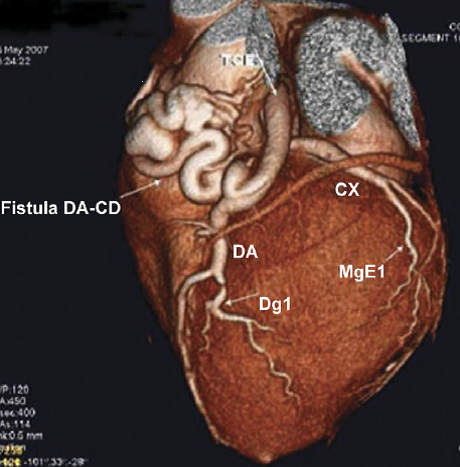 Fístula coronaria congénita, poco frecuente pero con tratamiento